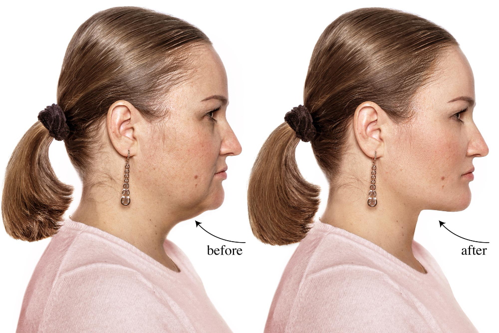 9 Effective Tips on How to Lose Face Fat: Low Budget Version - HansCo